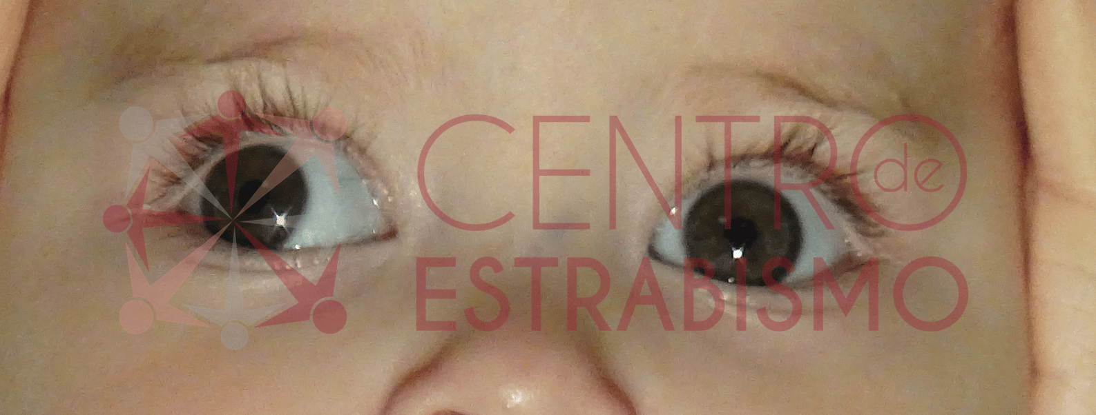 Comment puis-je corriger le strabisme de mon bébé ? - Blospot